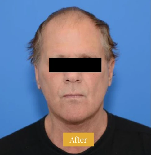 Mini Facelift/Short Scar Before & After Photos | The Virginia Institute ...